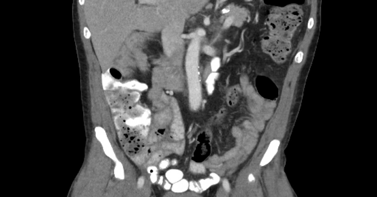 Abdominal Imaging | Department of Radiology | The University of Chicago